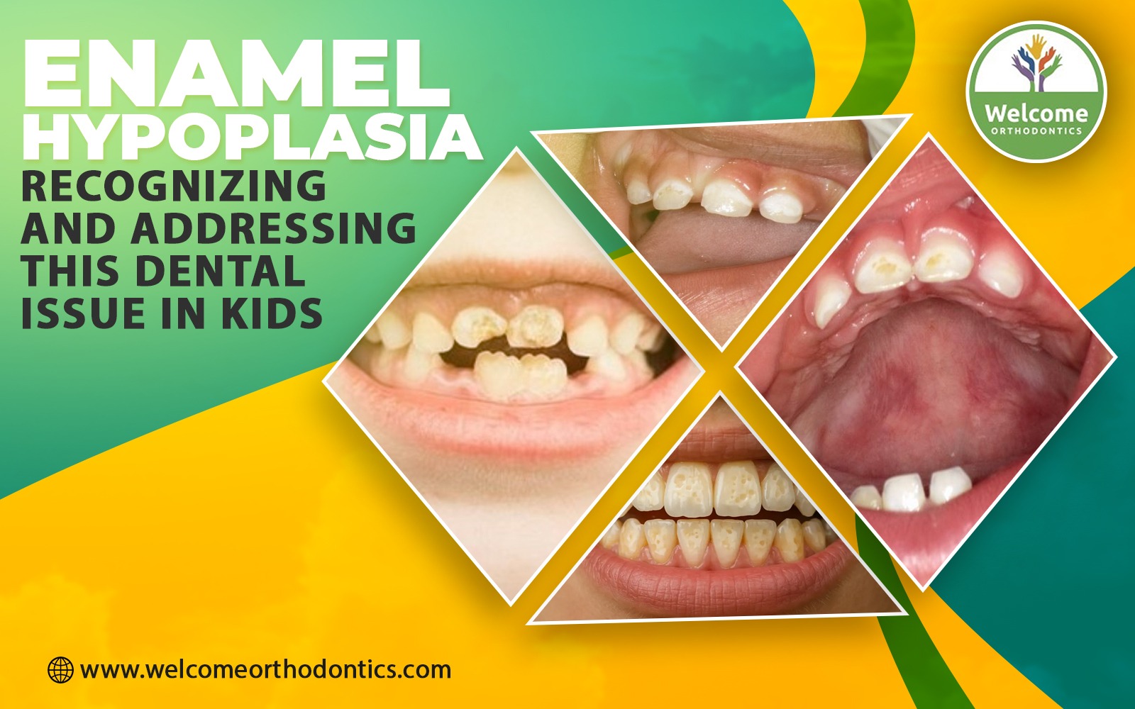 Enamel Hypoplasia